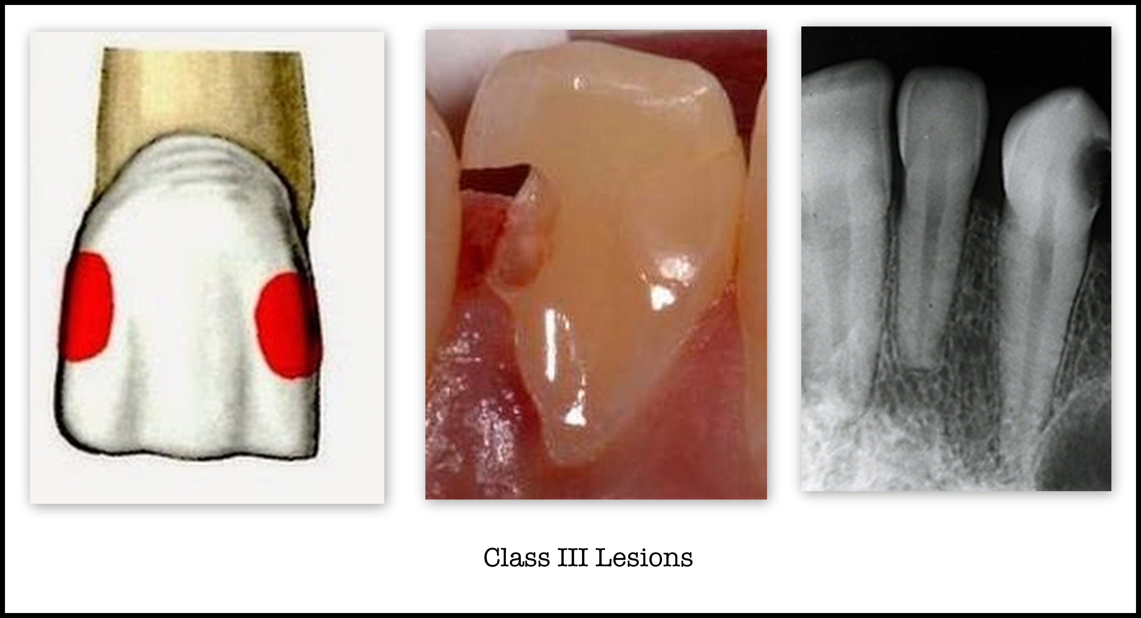 G.V. BLACK’S CLASSIFICATION OF CARIES | DENTODONTICS