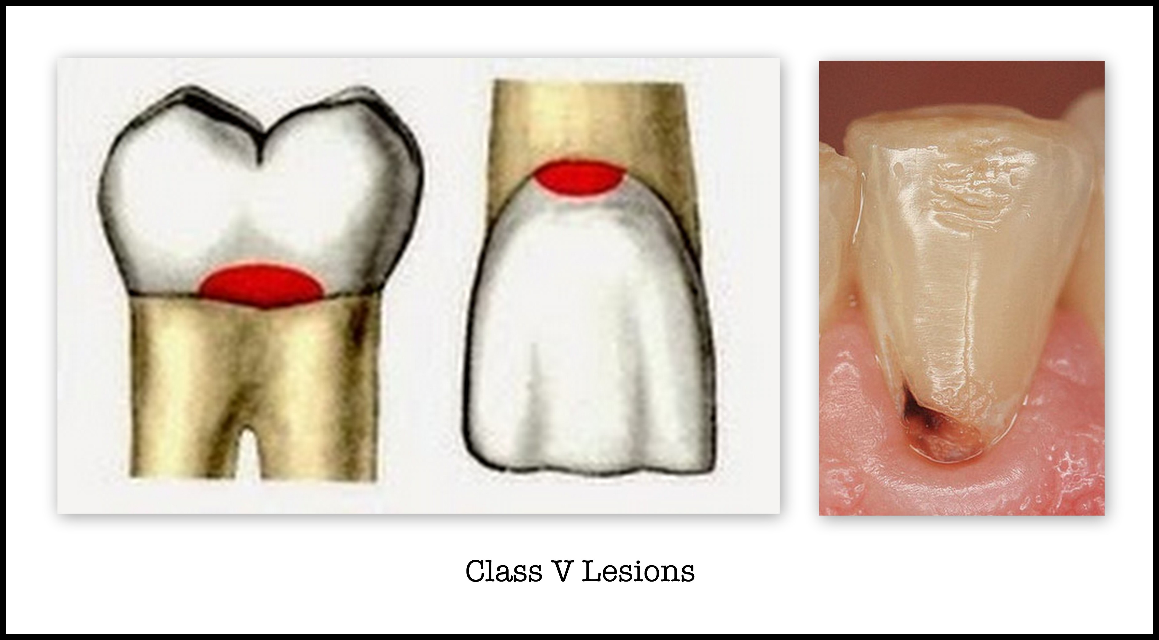 G.V. BLACK’S CLASSIFICATION OF CARIES | DENTODONTICS