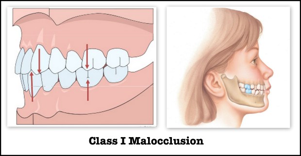 ANGLE’S CLASSIFICATION OF MALOCCLUSION | DENTODONTICS