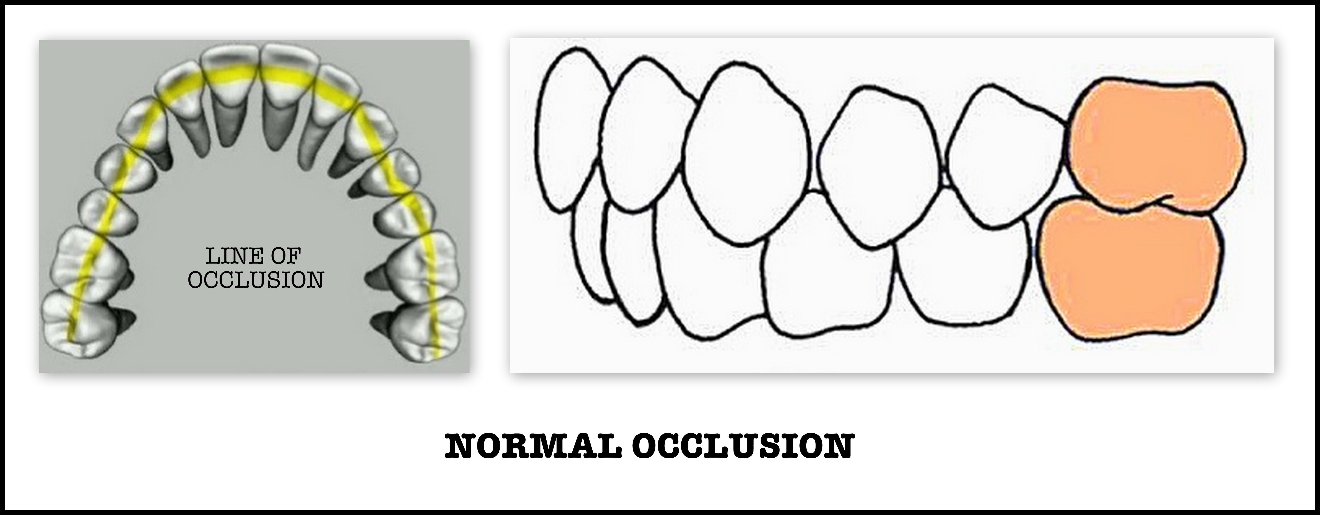 ANGLE’S CLASSIFICATION OF MALOCCLUSION | DENTODONTICS