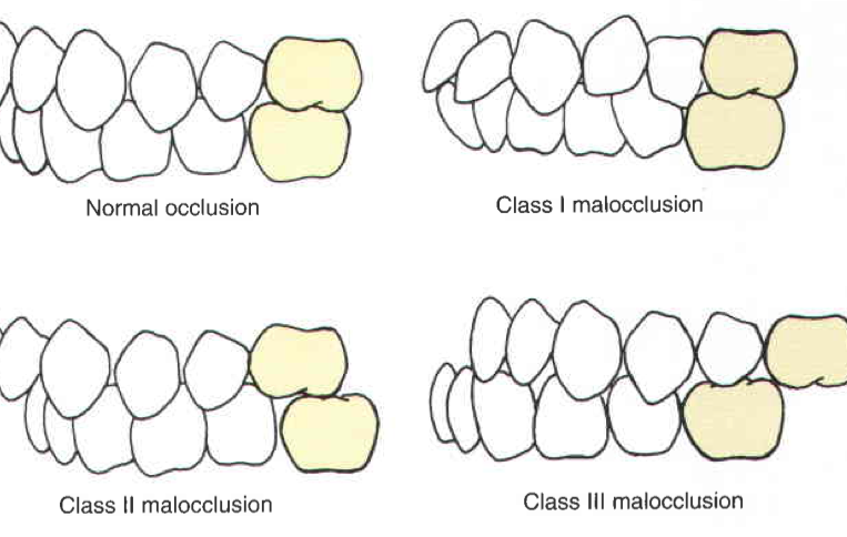 ANGLE’S CLASSIFICATION OF MALOCCLUSION | DENTODONTICS